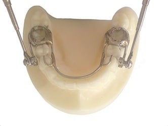 Herbst Appliances | OrthoDenco Orthodontic Lab