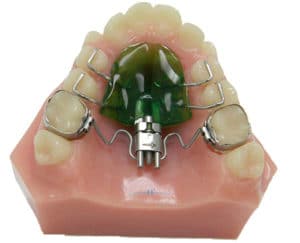 Digital Orthodontic Appliances | OrthoDenco Orthodontic Lab