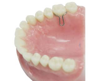 Orthodontic Retainers | OrthoDenco Orthodontic Lab