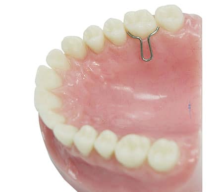 Orthodontic Retainers | OrthoDenco Orthodontic Lab