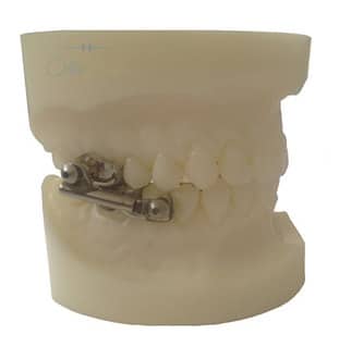 Herbst Appliances | OrthoDenco Orthodontic Lab