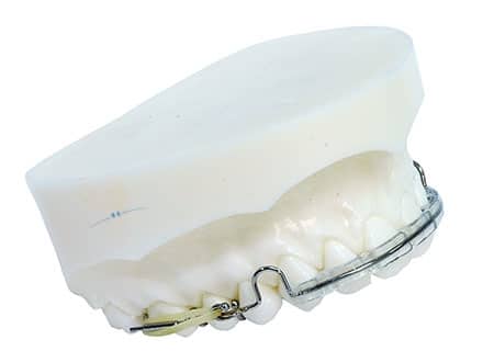 Orthodontic Retainers | OrthoDenco Orthodontic Lab