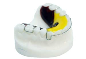 Dental Clasps | OrthoDenco Orthodontic Lab