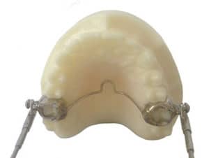 Herbst Appliances | OrthoDenco Orthodontic Lab