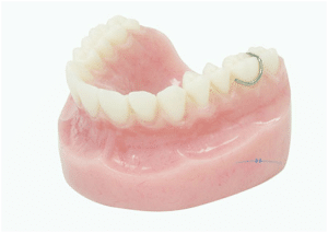 Dental Clasps | OrthoDenco Orthodontic Lab