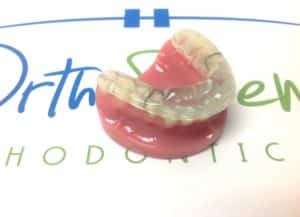 Occlusal Splints | OrthoDenco Orthodontic Lab