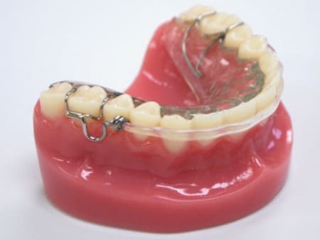 Orthodontic Retainers | OrthoDenco Orthodontic Lab